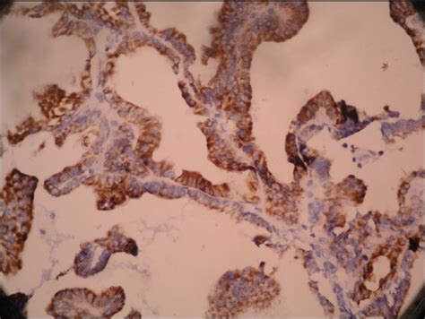 Choroid Plexus Carcinoma In An Adult Journal Of Neurosciences In