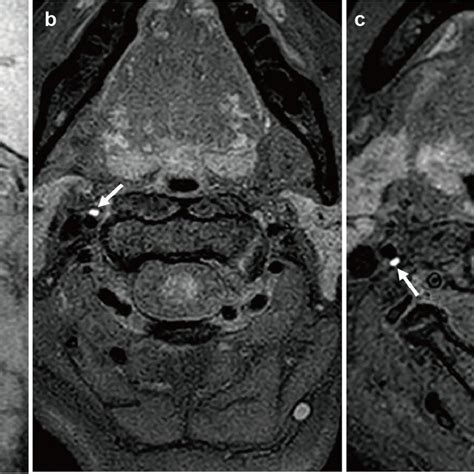 3 Month Follow Up Imaging A High Resolution Magnetic Resonance Imaging Download Scientific