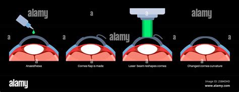 Illustration Of Lasik Laser Assisted In Situ Keratomileusis Also