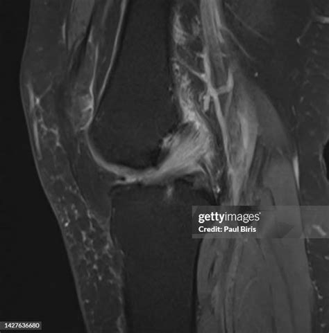 Tibia Anterior Stock Fotos Und Bilder Getty Images Tibia Anterior Stock Fotos Und Bilder Getty Images