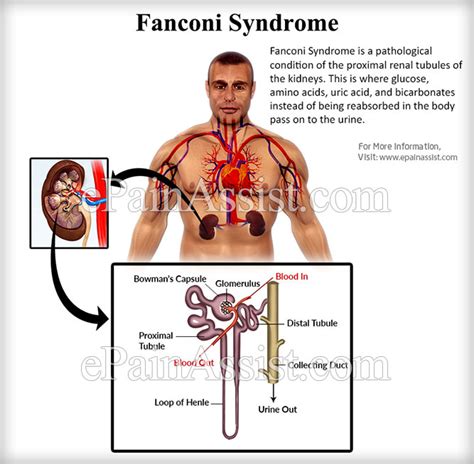 Fanconi Syndrome Treatment Causes Symptoms Diagnosis