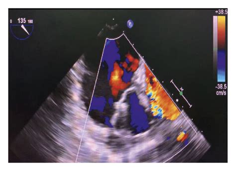 Left Atrial Appendage Closure After Catheter Ablation With Watchman