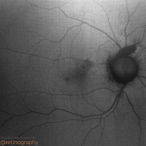 Polypoidal Choroidal Vasculopathy Retinography