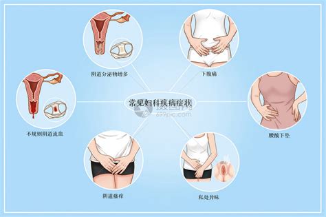 常见妇科疾病症状医疗插画插画图片下载 正版图片401959926 摄图网