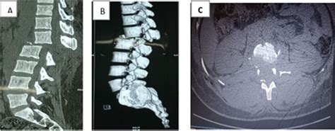Dichotomous Profile Of Thoraco Lumbar Dislocation Fractures Case Report And Review Of The