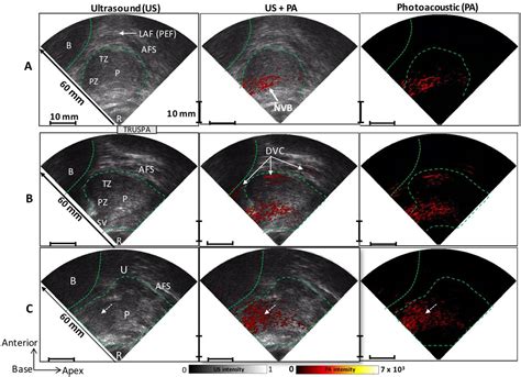 Prostate Anatomy Ultrasound