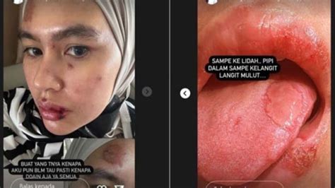 Kronologi Kartika Putri Terkena Penyakit Autoimun Dr Richard Lee