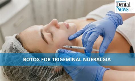 Botox For Trigeminal Neuralgia Your Esthetic Advisor