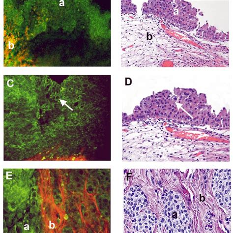Papillary Urothelial Carcinoma Low Grade Non Invasive Download Scientific Diagram
