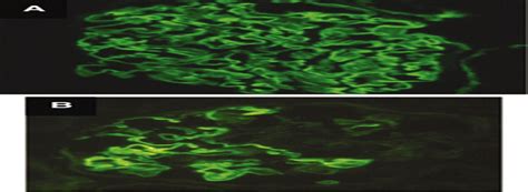 X Inactivation Female Mosaicism And Sex Differences In Ren Journal Of The American