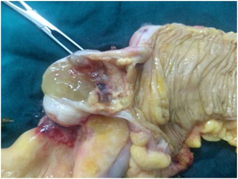 Macroscopic View Of Mucocele Appendix With Mucous As Content Download Scientific Diagram
