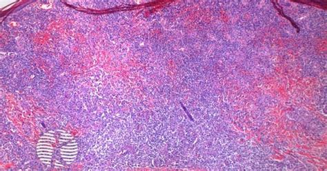 Lymphomatoid Papulosis Pathology Image