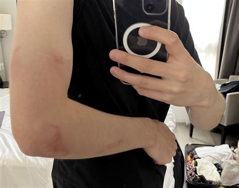 Mosquito Bites Or Bed Bugs Rbugbites