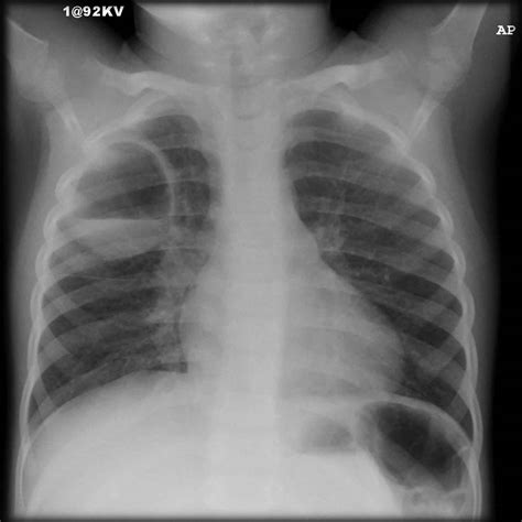 Pneumatocele Causes Symptoms Diagnosis Treatment And Prognosis
