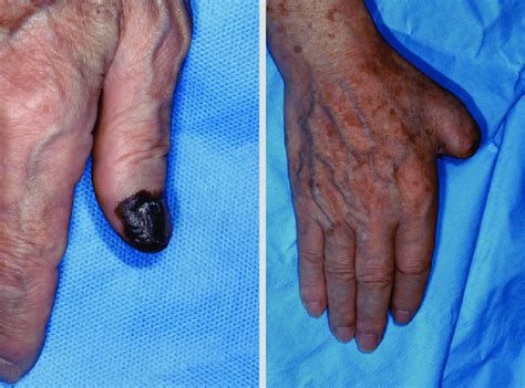 Acral Lentiginous Melanoma Metastatic Melanoma