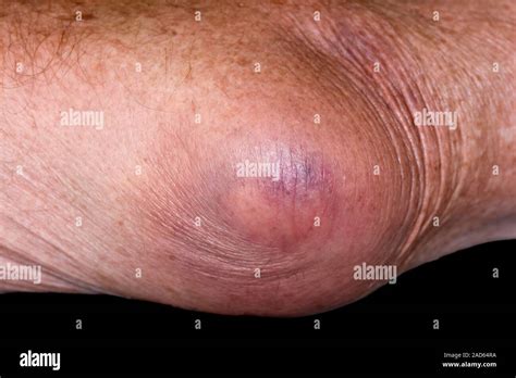 Bursitis Of The Elbow Close Up Of The Inflamed Elbow Olecranon Of A