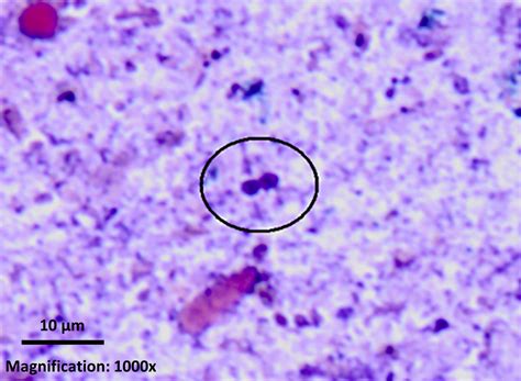 Gastrointestinal Polyposis And Microsporidia Infection In A Hiv