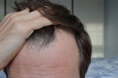 Top 117 Bumps On Scalp Under Hair Polarrunningexpeditions