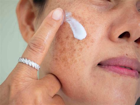 What You Need To Know About Melasma Victorian Dermal Institute