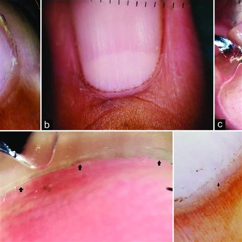 A Onychoscopy Of Lichen Planus In Nail Plate Shows Multiple