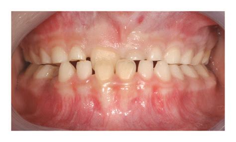 Frontal View Of The Patient Class Iii Occlusion Download Scientific Diagram