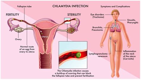 Chlamydia Trachomatis An Overview Microbe Notes
