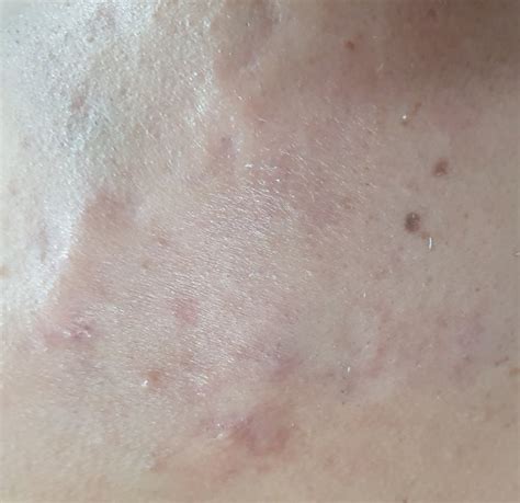 켈로이드 여드름 네이버 블로그