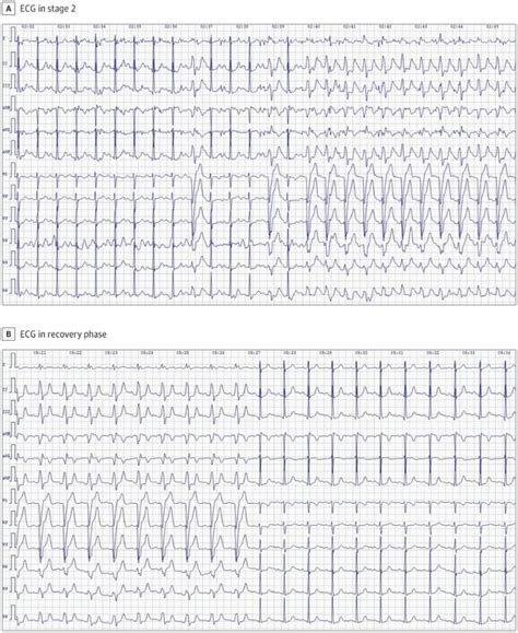 Jama Internal Medicine On Linkedin Exercise Induced Left Bundle Branch Block