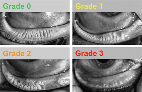 Efficacy And Utility Of Clinical Examination In Predicting Meibomian