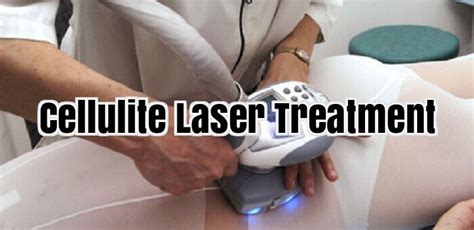 Cellulite Laser Treatment Benefits And What To Expect