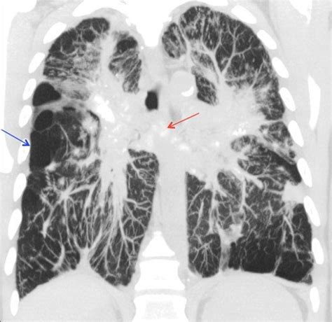 Silicosis Eggshell Calcification