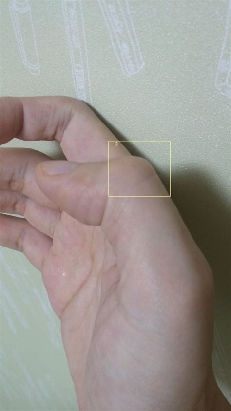 엄지손가락 첫번째 마디 쪽 뼈돌출여부 전문의상담