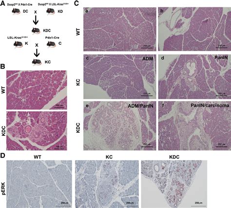 Loss Of Dusp2 In The Pancreas Facilitates The Progression Of