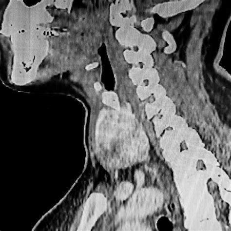 Thyroid Nodule Treatments Nyc Dr John Salerno