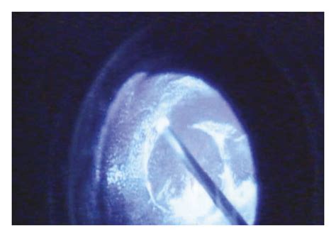 Formation Of Surgical Posterior Vitreous Detachment Pvd A The Download Scientific Diagram