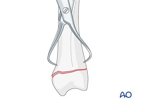 Compression Plating For Extraarticular Fracture Of The Proximal End Segment