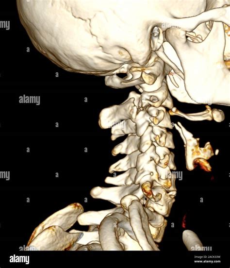 Broken Neck Coloured 3d Computed Tomography Ct Scan Of The Neck Of A
