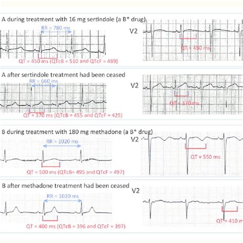 Figure A1 Two Cases Of Drug Induced Qt Prolongation Patient A A Download Scientific Diagram