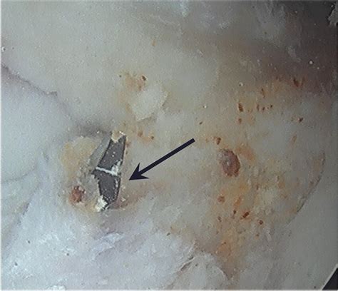 Tibial Tunnel Placement Left Knee Shown Existing The Centre Of The Tibial Tunnel Placement Left Knee Shown Existing The Centre Of The