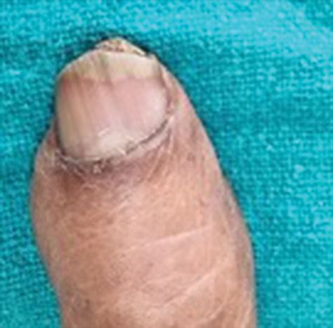 Self Induced Nail Disorders Journal Of Onychology And Nail Surgery