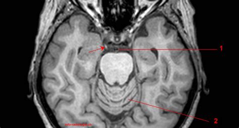 Nerf Oculomoteur émergence Et Trajet En Irm