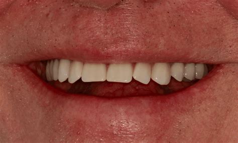 Full Arch Implants Harrogate Dental And Implant Clinic