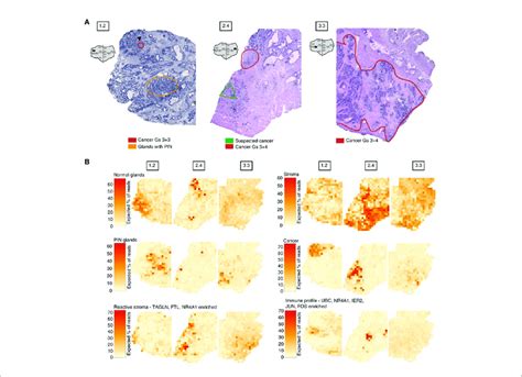 Example Of Spatial Transcriptomic Analysis On Three Prostate Cancer Download Scientific