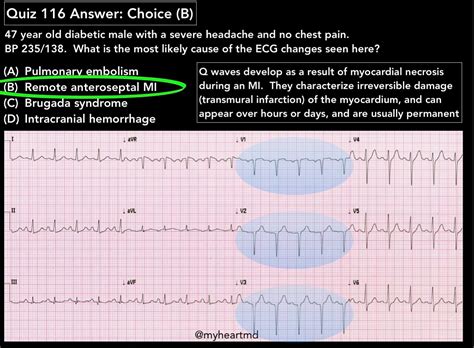 Sush Prusty Md Er Physician An Anteroseptal Myocardial Infarction Is A Type Of Myocardial