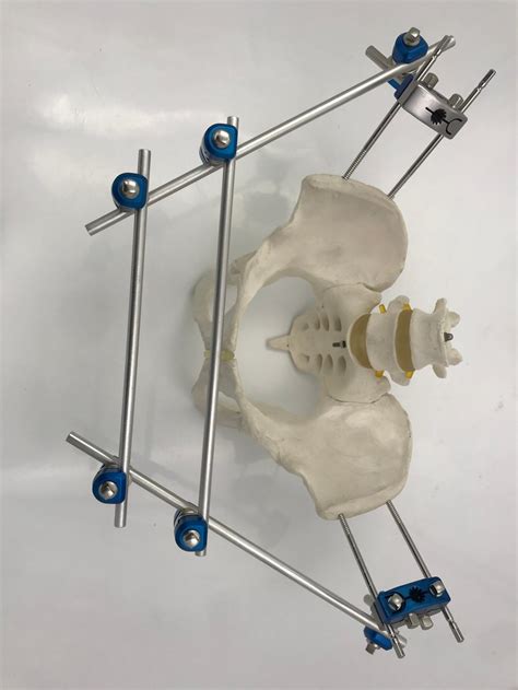 Hot Selling Combination External Fixator Pelvic Fixator External Fixator And Surgical