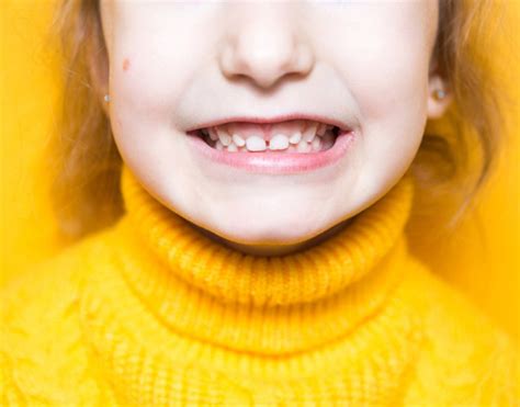 Deepbite Understanding And Correcting Overbites