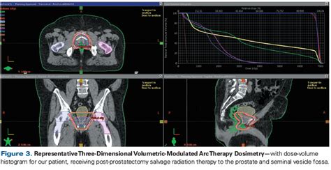 Salvage Radiation Therapy After Radical Prostatectomy Doctorvisit