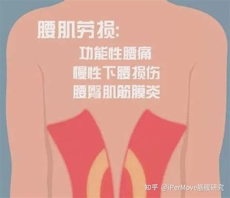 体育生常见伤病专题（二）——腰肌劳损！体育生必看！ 知乎