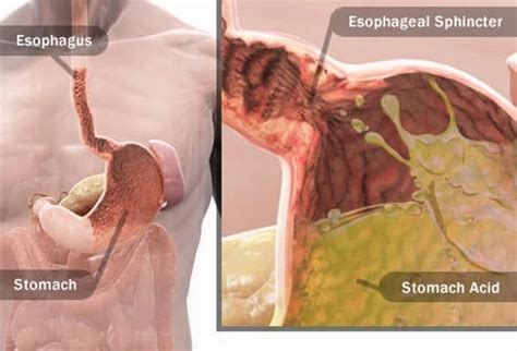 Visual Guide To Understanding Heartburn And Gerd
