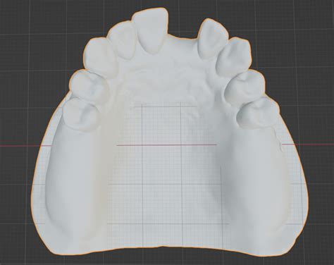 Archivo Stl Prosthodontics Kennedy Class I Mod 1 Maxillary Removable Partial Denture Rpd 🎒